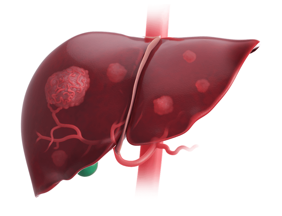 Intrahepatic Cholangiocarcinoma (ICC) Treatment Approach
