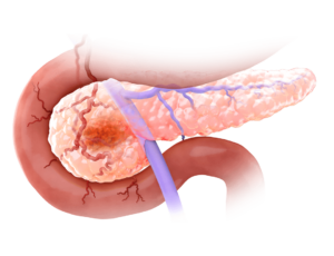 Pancreatic Ductal Adenocarcinoma Treatment Approach
