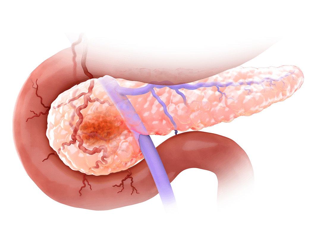 Pancreatic Ductal Adenocarcinoma Treatment Approach