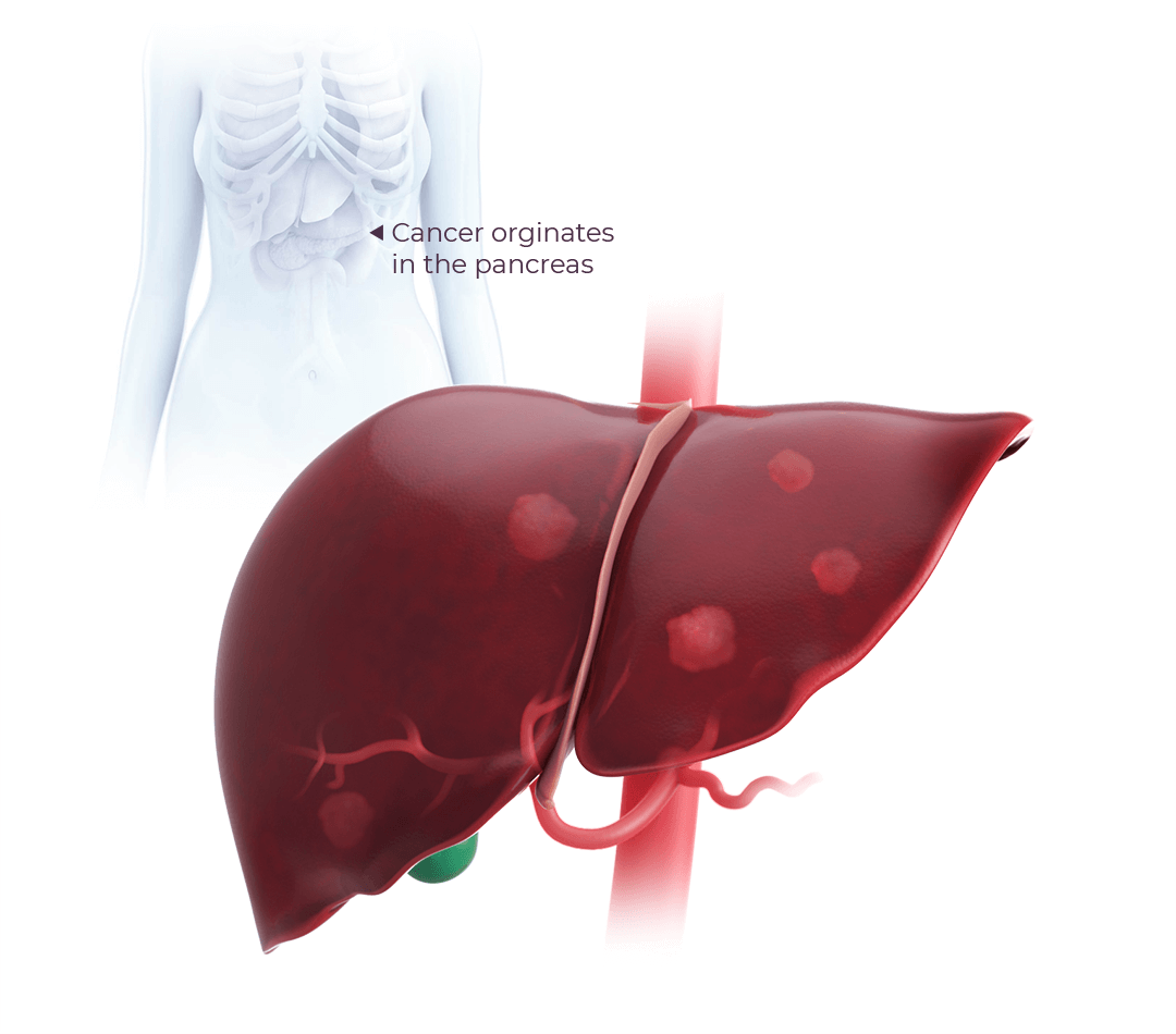 PDAC with Liver Metastases Treatment Approach
