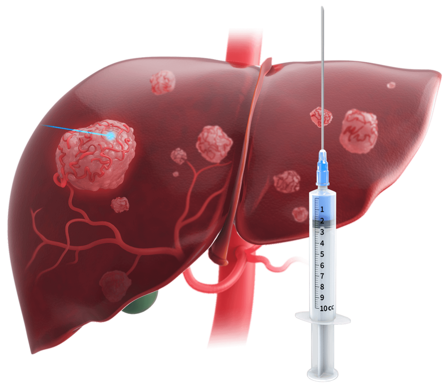 Science - Overcoming Intratumoral Pressure
